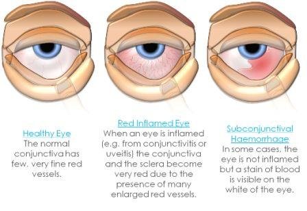 Causes of Red Eye - Symptoms, Reasons and Why You Have Red Eyes
