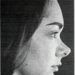 Upturned Nose or Concave Nose Meaning, Rhinoplasty, Before & After Pictures