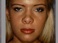 Upturned Nose or Concave Nose Meaning, Rhinoplasty, Before & After Pictures