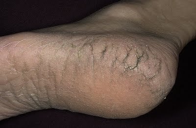 How to Heal Cracked Feet, Home Remedies, Causes, Diabetes, Extremely ...