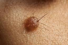 Hairy Moles on Face, Why Are Moles Hairy, Images, Cancer, Hairy Mole ...