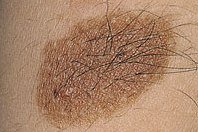 Hairy Moles on Face, Why Are Moles Hairy, Images, Cancer, Hairy Mole ...