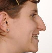 Hook Nose Meaning, Jewish Hooked Nose, Hook Nose Rhinoplasty