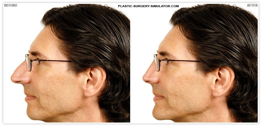 Nose Job Simulator, Virtual Nose Job, Free, Online Virtual Nose Surgery