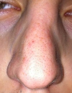 Nose Pain On Nose Bridge, Inside, Inner, Broken & Nose Pain on One Side
