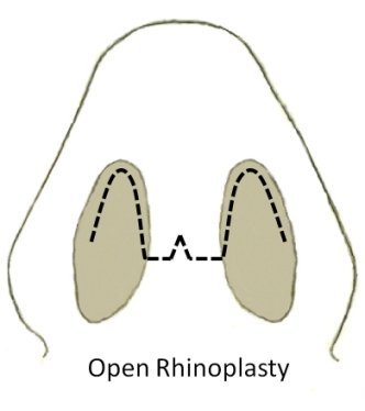Open Rhinoplasty & Closed Rhinoplasty Costs, Recovery, Before & After ...
