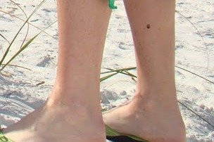 Painful Moles on Back, Face, Neck, Leg, Scalp & Painful Raised Moles