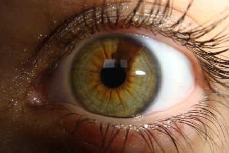 Birthmark in Eye Meaning, Sectoral Heterochromia Birthmark, Actresses ...