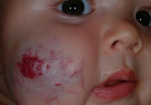 Birthmark Meaning, Location, Shape, Pictures, Past Lives, Spiritual ...