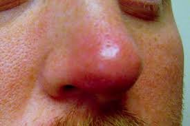 Swollen Nose Causes Red Bridge On Nose Tip During Pregnancy And