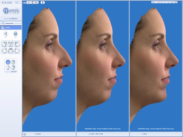 Nose Job Simulator, Virtual Nose Job, Free, Online Virtual Nose Surgery