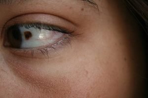 Birthmark Meaning, Location, Shape, Pictures, Past Lives, Spiritual ...