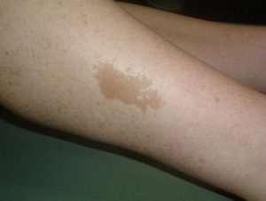Birthmark Meaning, Location, Shape, Pictures, Past Lives, Spiritual ...