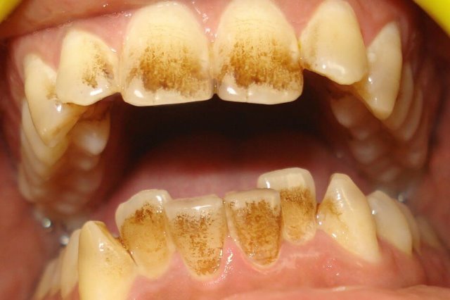 Teeth Stains: Types (Tea, Coffee) Pictures, Causes and Removal
