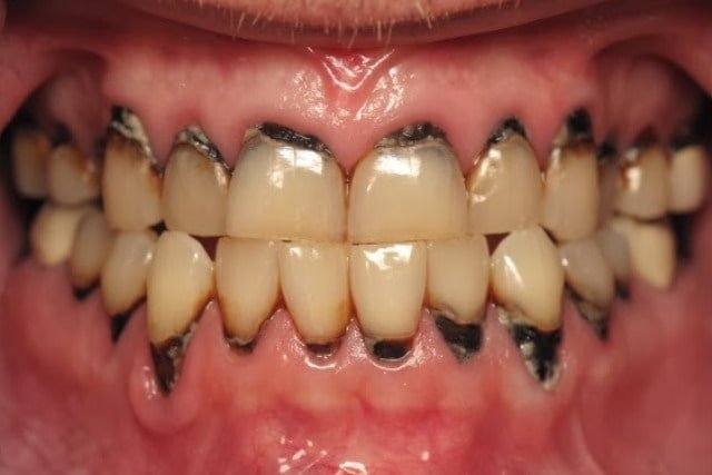 Teeth Stains: Types (Tea, Coffee) Pictures, Causes and Removal