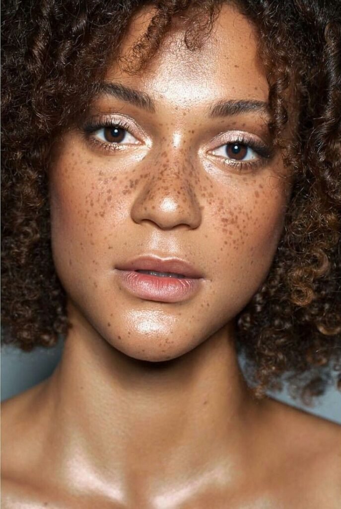 What Are Freckles – Medical Term, How to Prevent Freckles, Lindsay Lohan