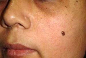 Mole Meanings on Body & Face: Male, Female, Lucky or Unlucky
