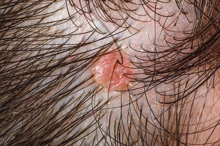 Mole on Scalp - Red, Pink, Black, White, Raised, Cancerous, Mole on ...