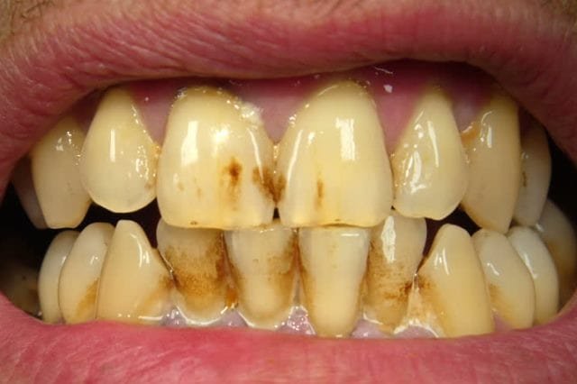 Teeth Stains: Types (Tea, Coffee) Pictures, Causes and Removal